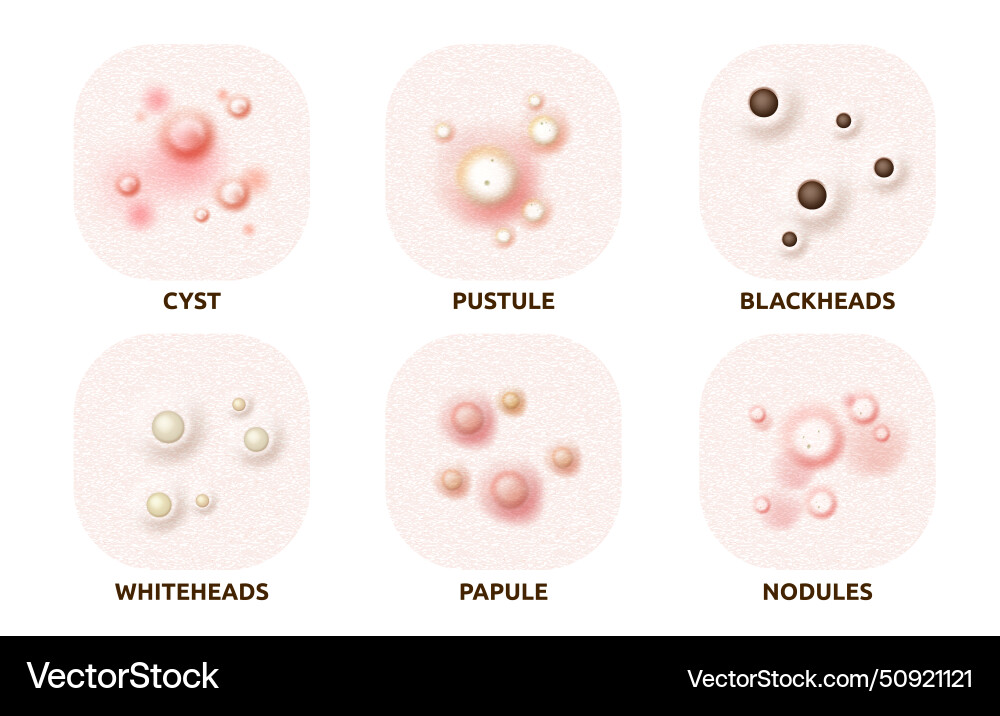 Body skin acne type 3d disease pimples Royalty Free Vector
