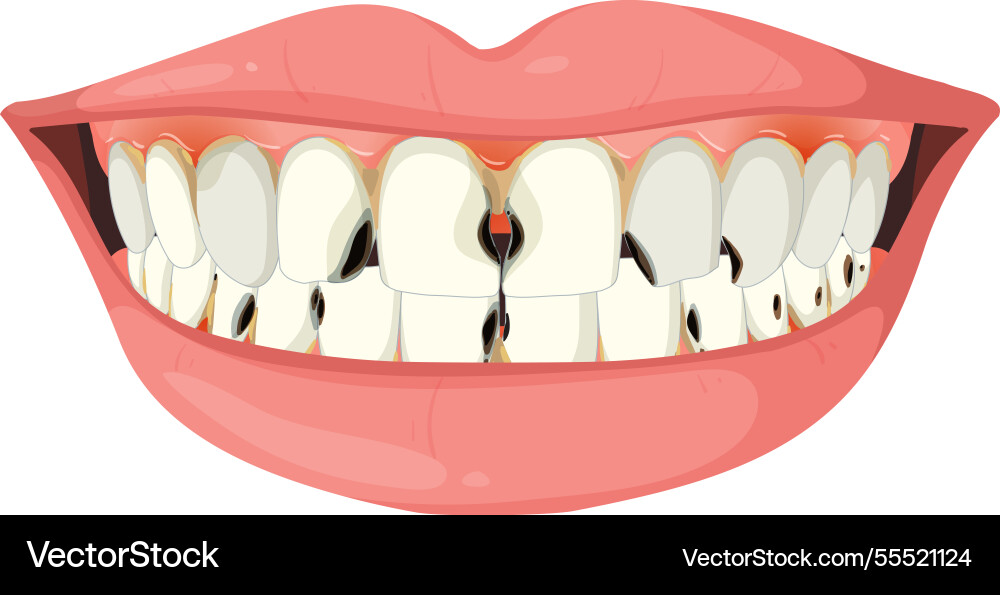 Showing teeth with visible decay and damage Vector Image