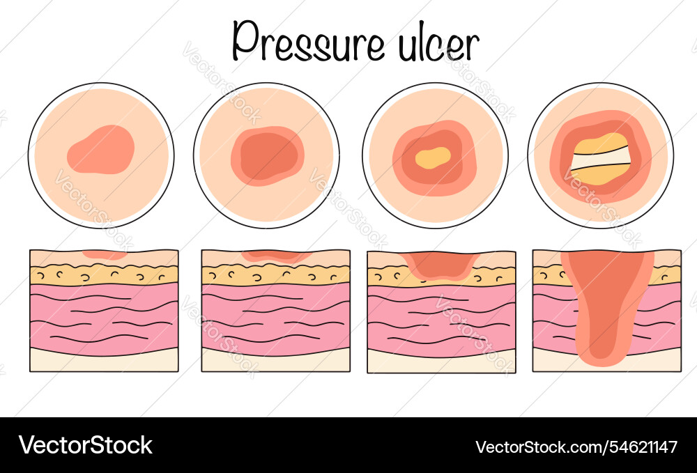 Pressure ulcer Royalty Free Vector Image - VectorStock