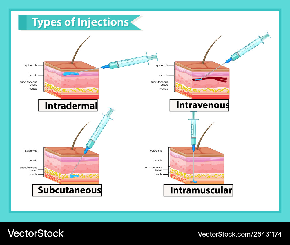 Injection Types: Anatomical Overview Royalty Free Vector