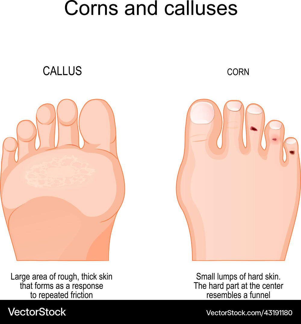 Corns on toe and calluses sole Royalty Free Vector Image