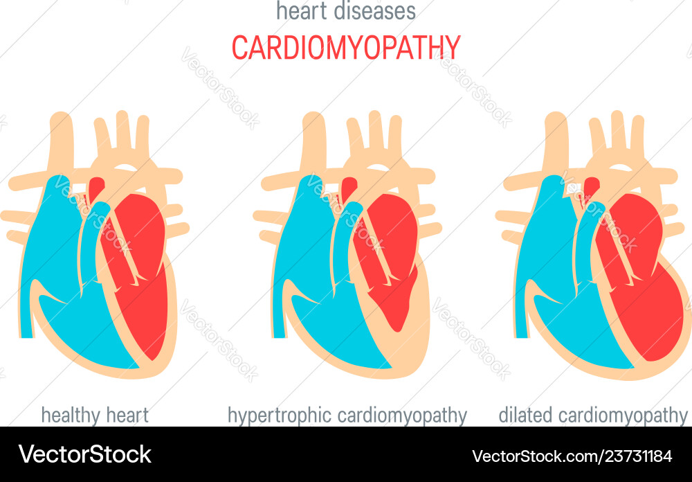 Heart disease concept in flat style Royalty Free Vector