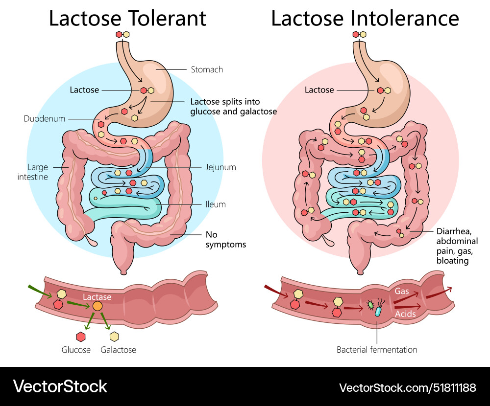 Lactose tolerance vs intolerance diagram medical Vector Image