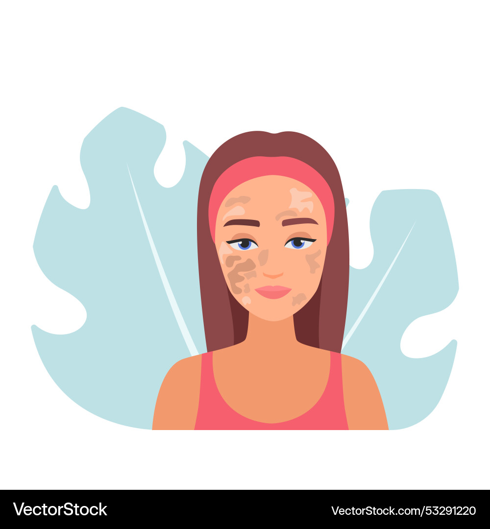 Woman with melasma and hyperpigmentation Vector Image