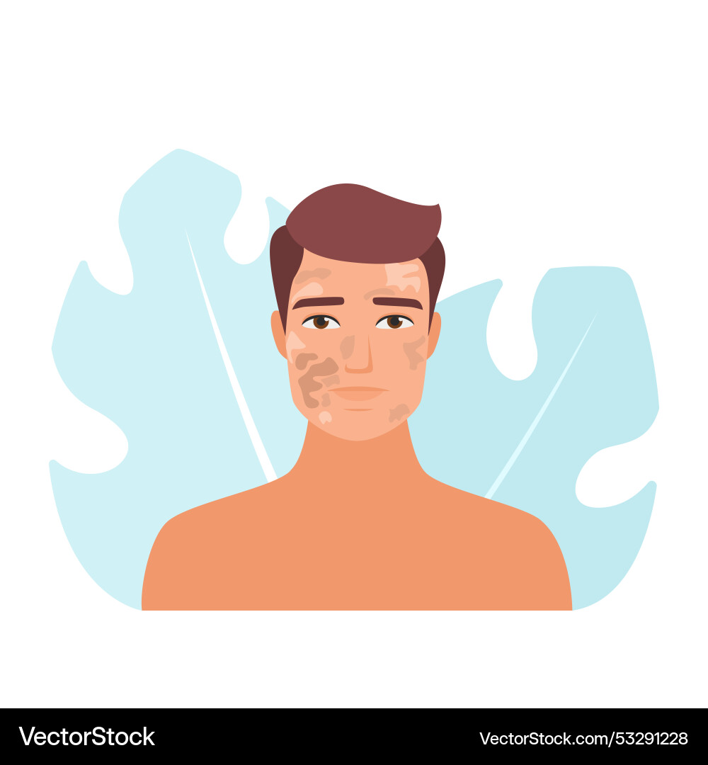Man with melasma and hyperpigmentation Royalty Free Vector