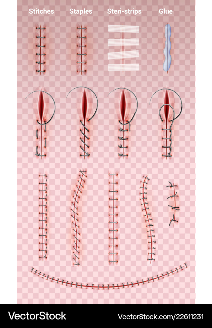 Surgical Stitching Set - Medical Sutures Vector Image