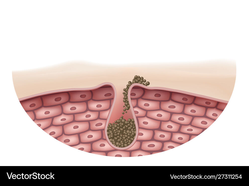 Dirty skin Royalty Free Vector Image - VectorStock