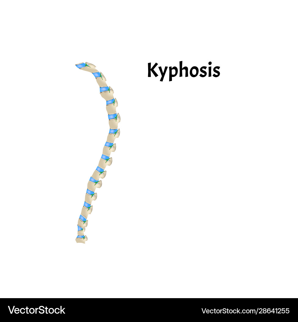 Position spine with kyphosis spinal Royalty Free Vector