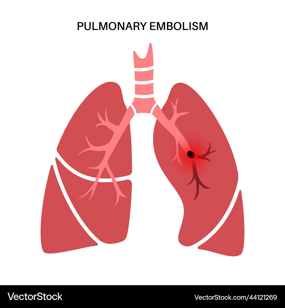 Pulmonary Embolism Anatomy Royalty Free Vector Image