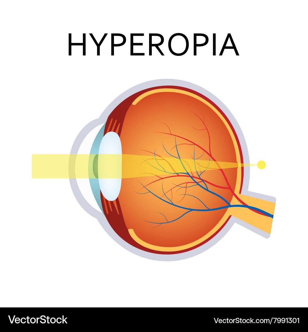 Hyperopia eyesight disorder Royalty Free Vector Image