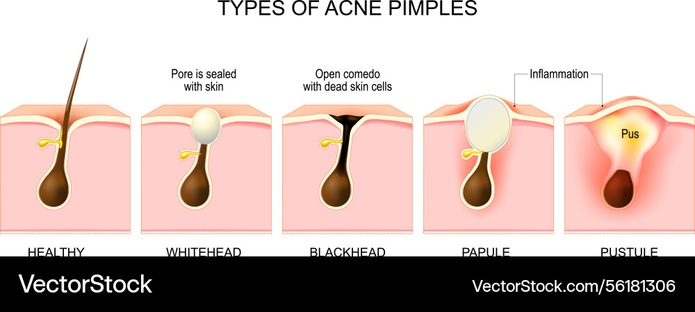Arten von Akne-Pimples Querschnittshaut Lizenzfreier Vektor