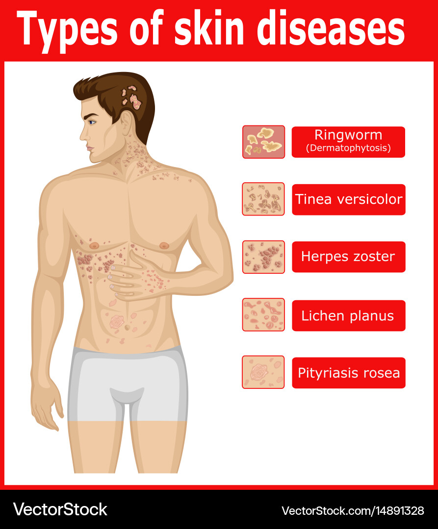Types of skin diseases Royalty Free Vector Image