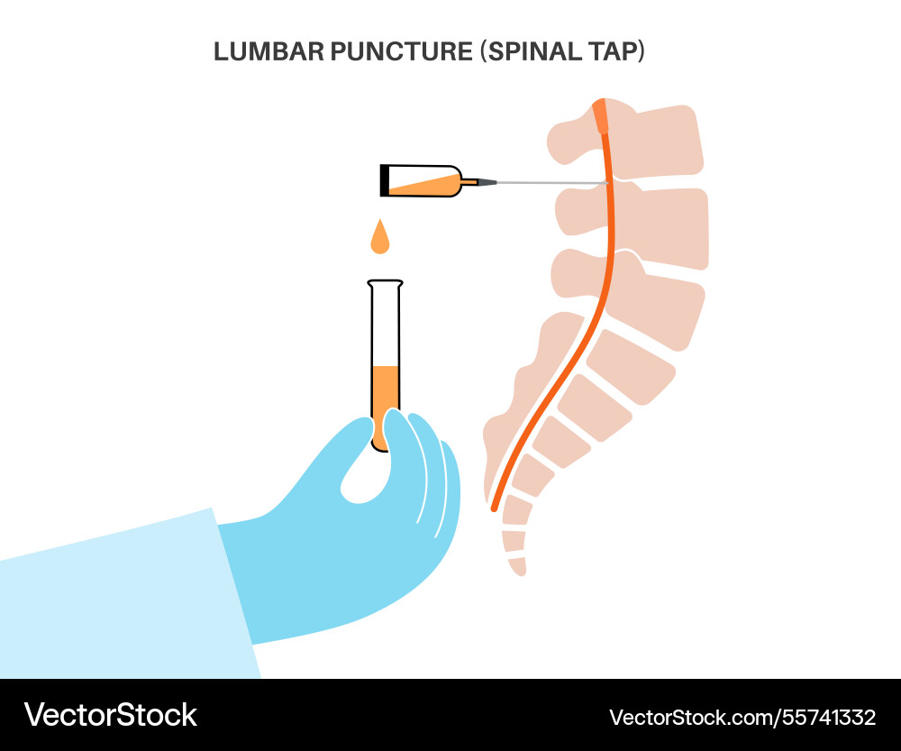 Lumbar punktion spinal tippe Lizenzfreies Vektorbild
