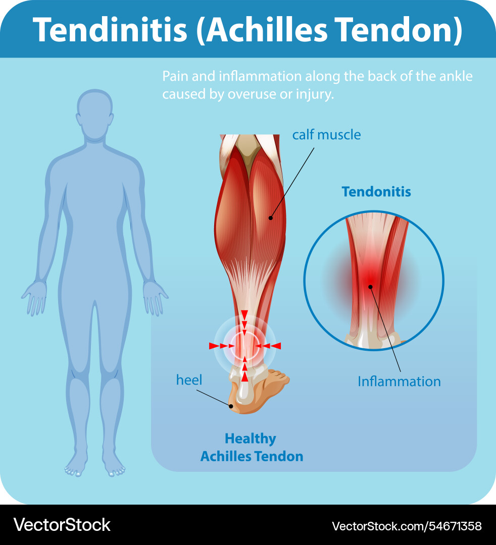 Diagram showing achilles tendon inflammation Vector Image