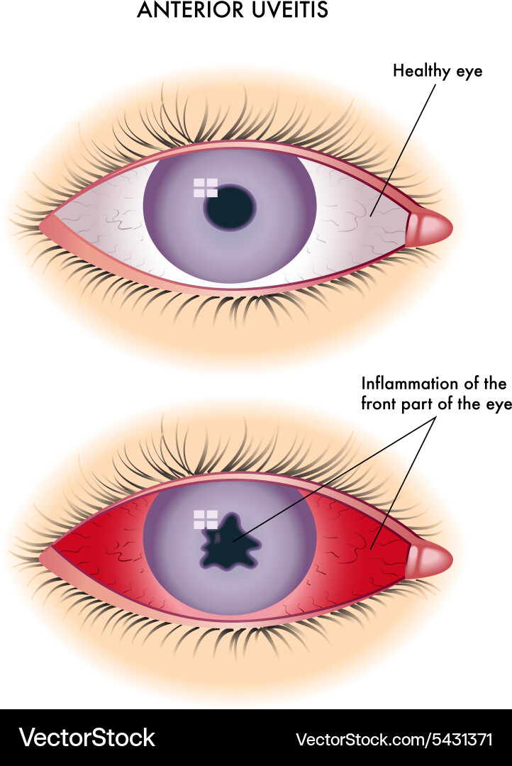 Photophobia Vector Images (52)