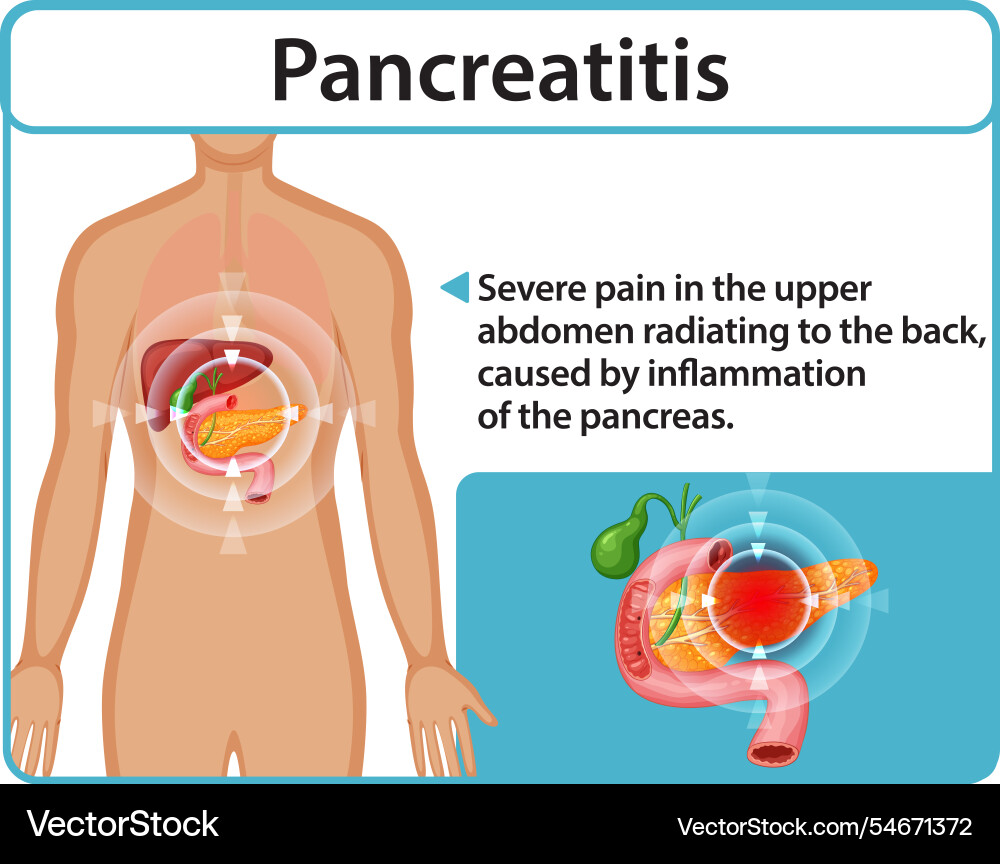 Pancreatitis symptoms and affected organs Vector Image