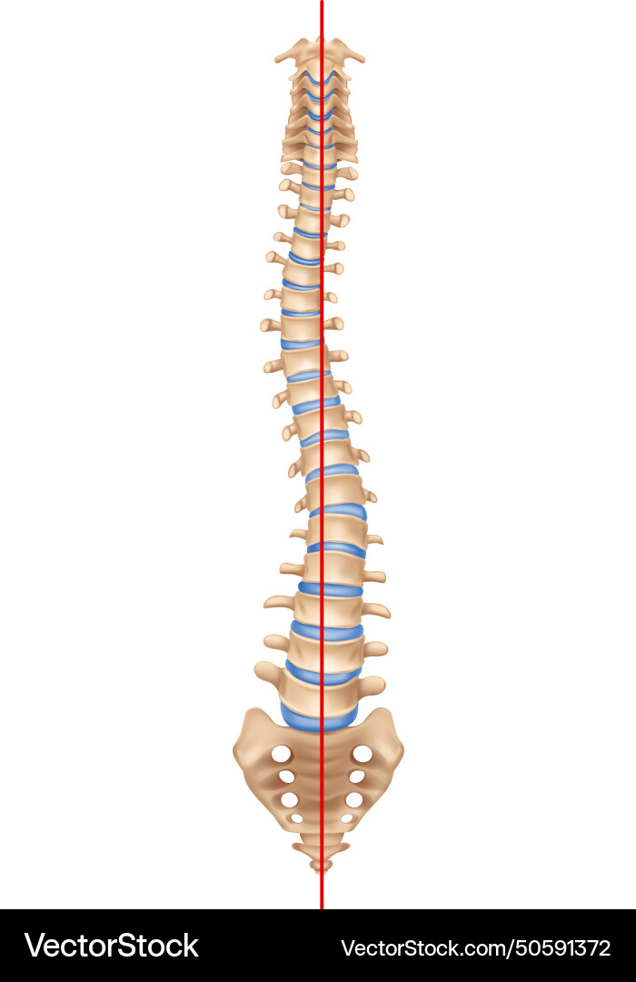 Realistic spine scoliosis composition Royalty Free Vector