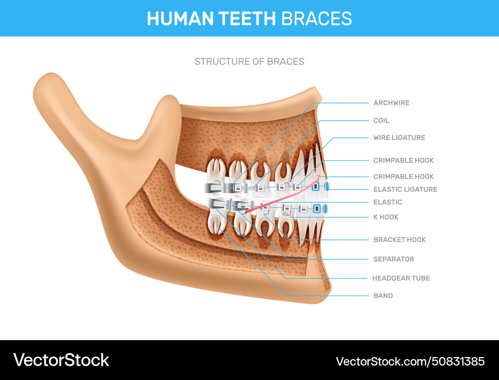 Human teeth braces realistic infographics Vector Image