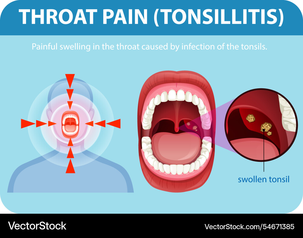 Tonsillitis symptoms and throat anatomy Royalty Free Vector