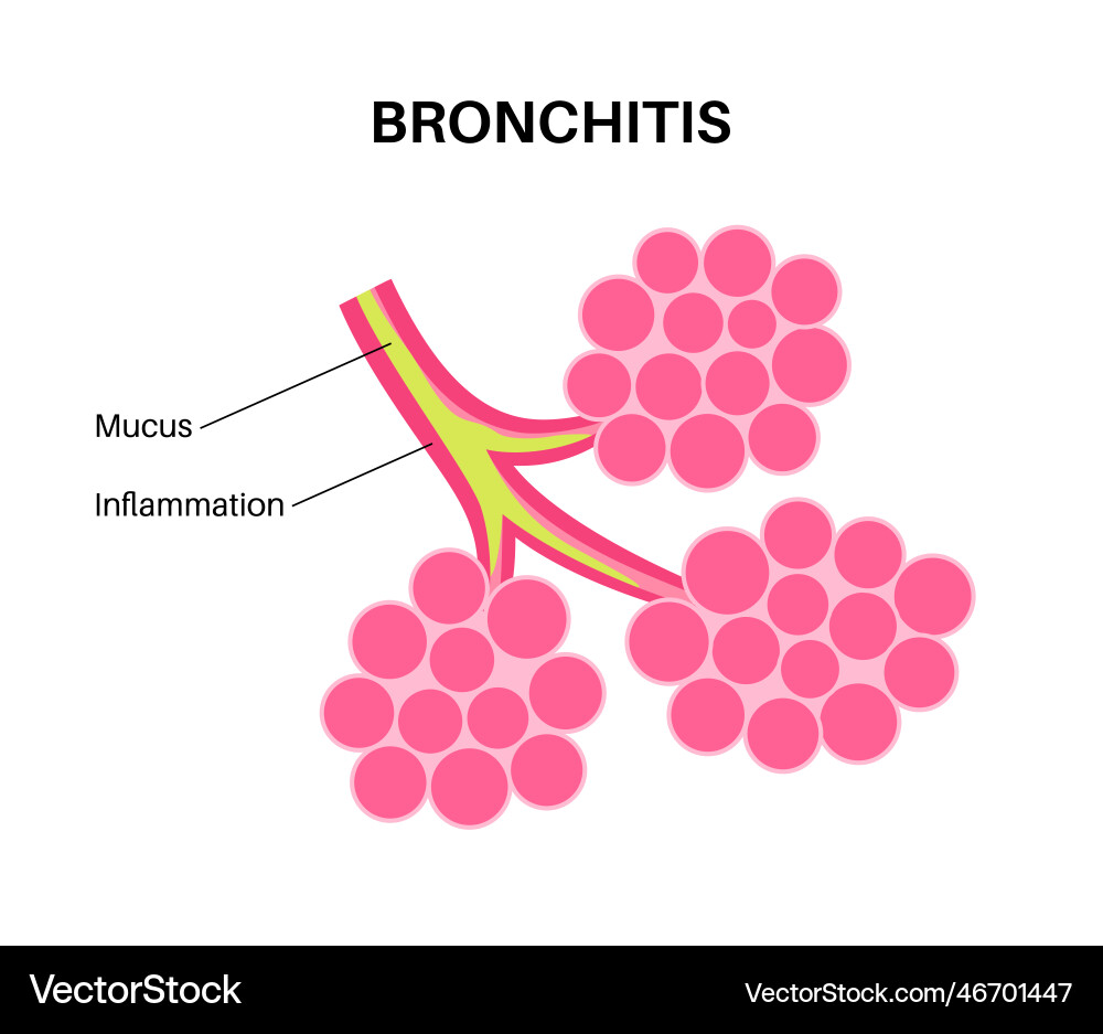 Bronchitis lung disease Royalty Free Vector Image