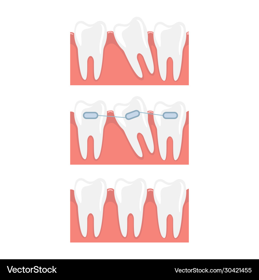 Braces set Royalty Free Vector Image - VectorStock