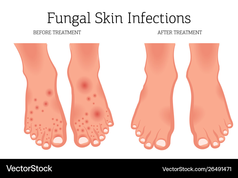 Fungal diseases skin Royalty Free Vector Image