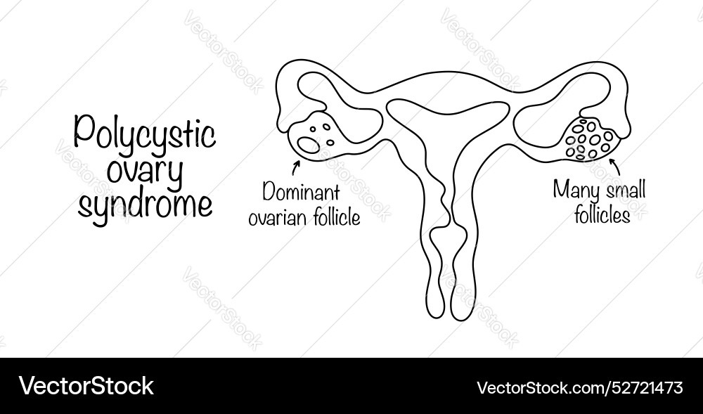 Polycystic ovary syndrome Royalty Free Vector Image