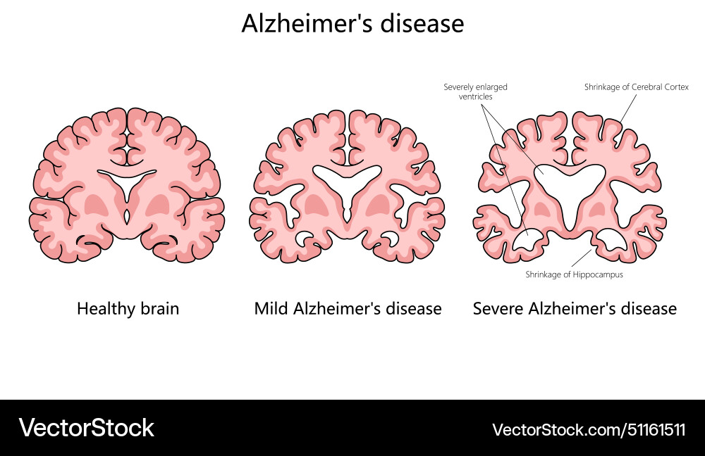 Progression of alzheimer disease in brain diagram Vector Image