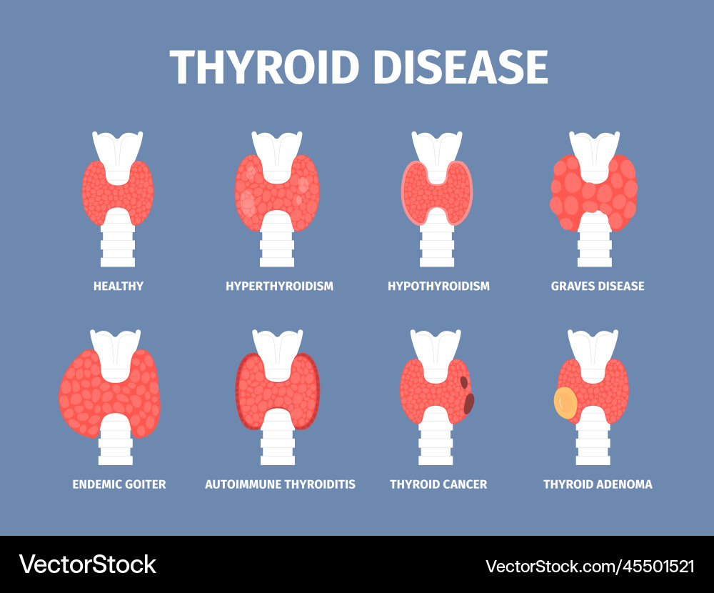 Thyroid Disease and Goiter Royalty Free Vector Image