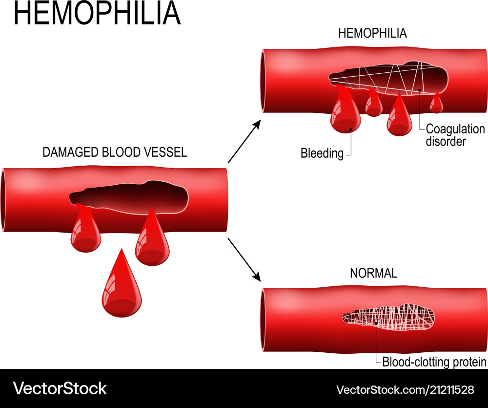 Hemophilia: Blood Clotting Disorder Royalty Free Vector