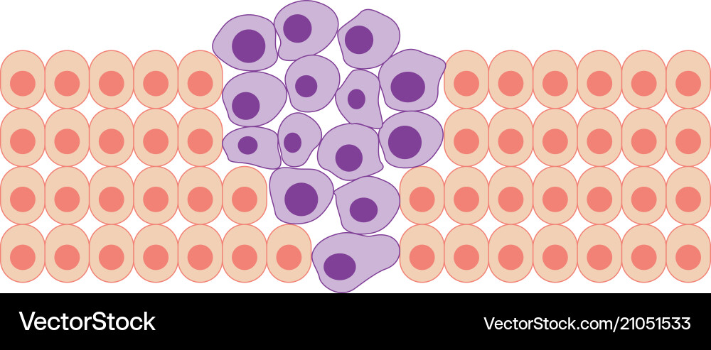 Tumor Skin Vector Images (over 680)