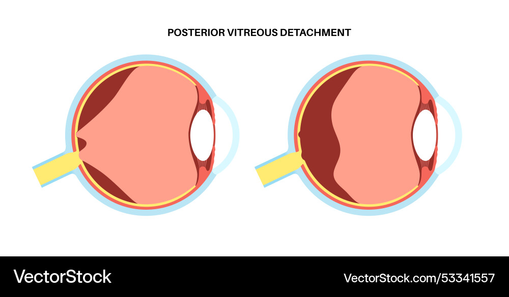 Posterior vitreous detachment Royalty Free Vector Image