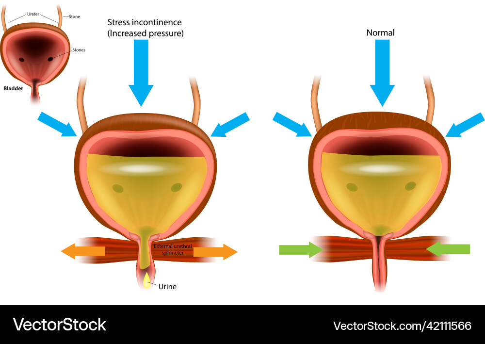 Overactive bladder oab and normal Royalty Free Vector Image