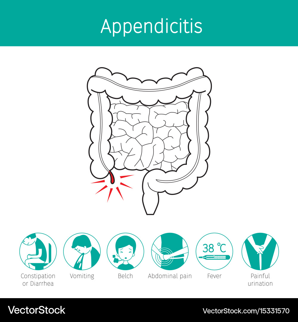 Human Intestine & Appendicitis Anatomy Vector Image