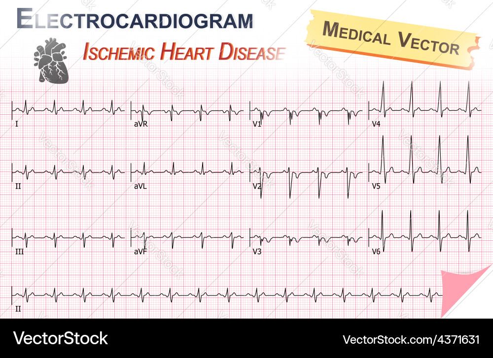 Electrocardiogram Royalty Free Vector Image - VectorStock
