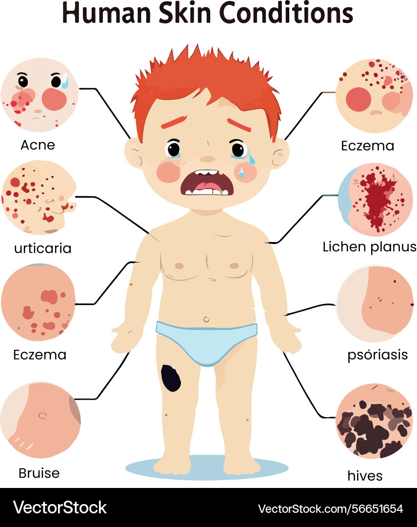 Human skin condition information Royalty Free Vector Image