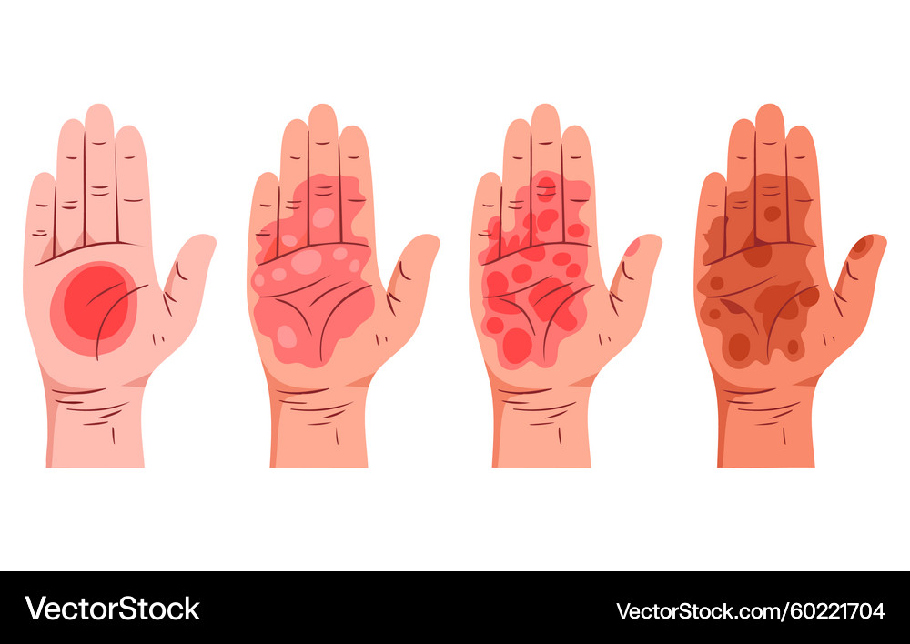 Human Hand Burn Degrees of Severity – Royalty-Free Vector | VectorStock