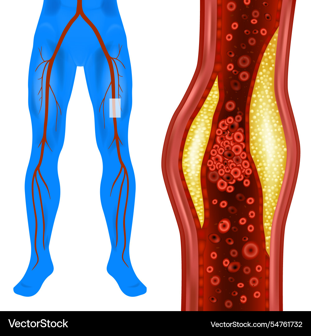 Leg Artery Blockage – Atherosclerosis – Royalty-Free Vector | VectorStock
