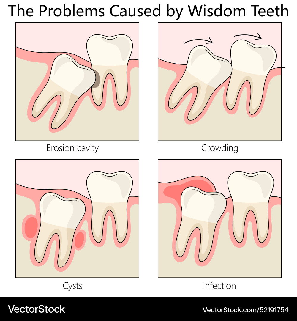 Problems caused by wisdom teeth diagram medical Vector Image