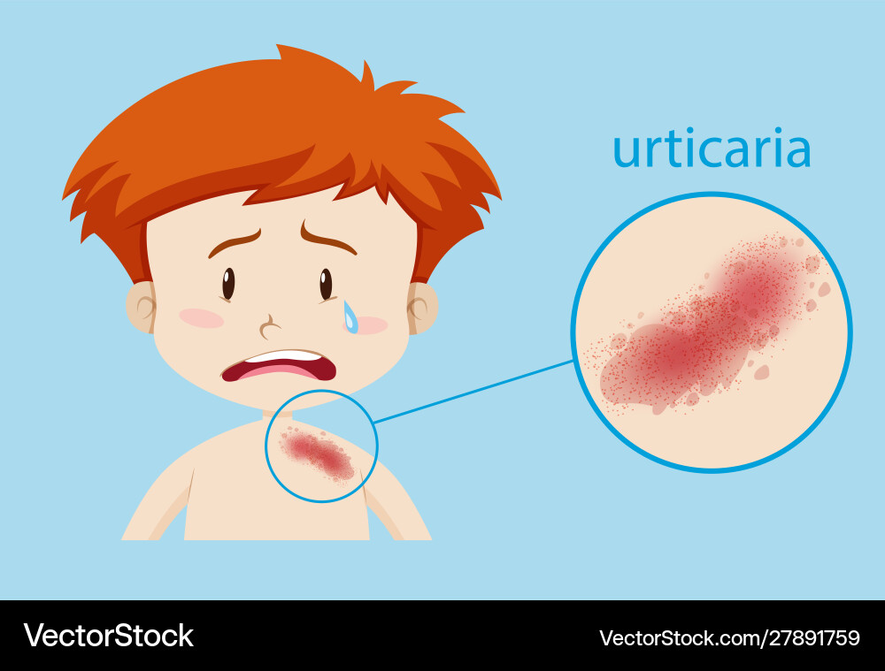 Diagram showing boy with urticaria Royalty Free Vector Image