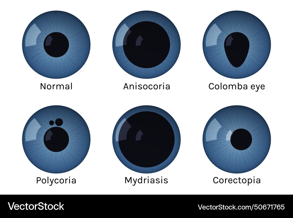 Eye pupils set with disease normal Royalty Free Vector Image