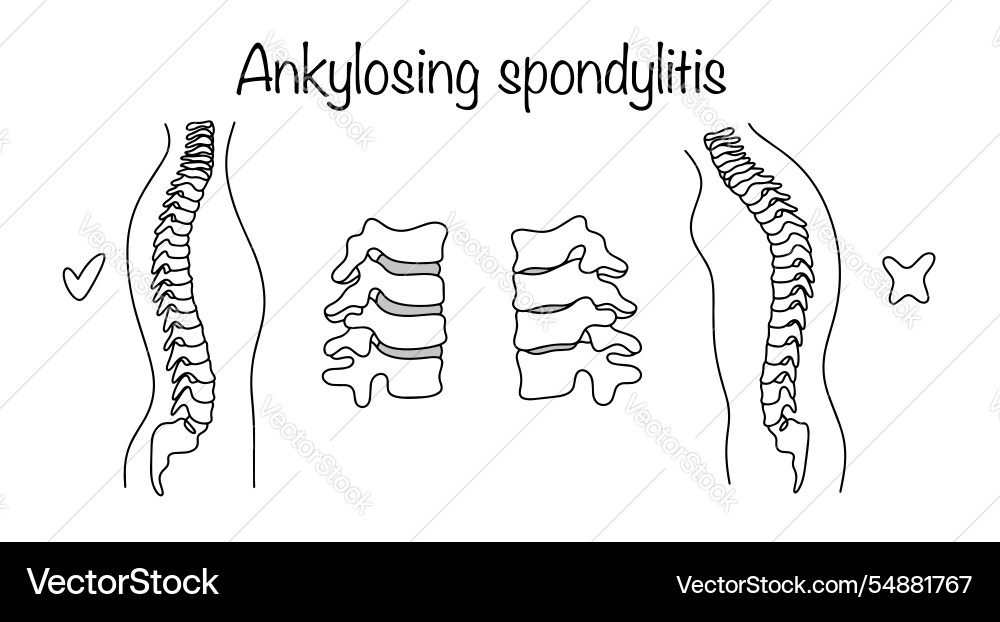 Spondylolisthesis Vector Images (64)