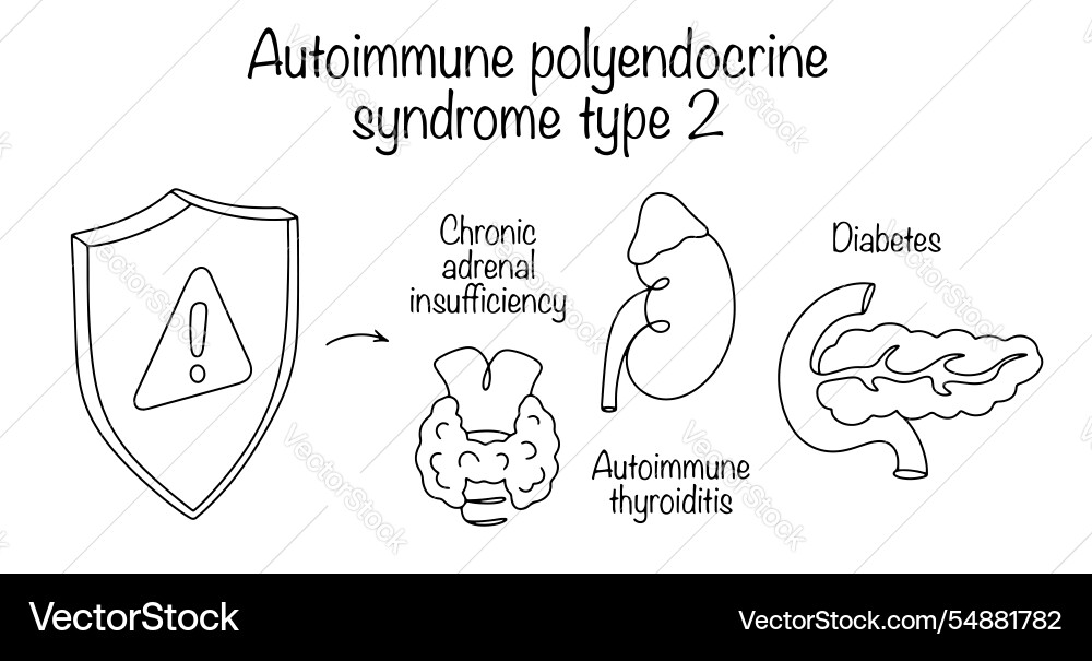 Autoimmune polyendocrine syndrome type 2 Vector Image