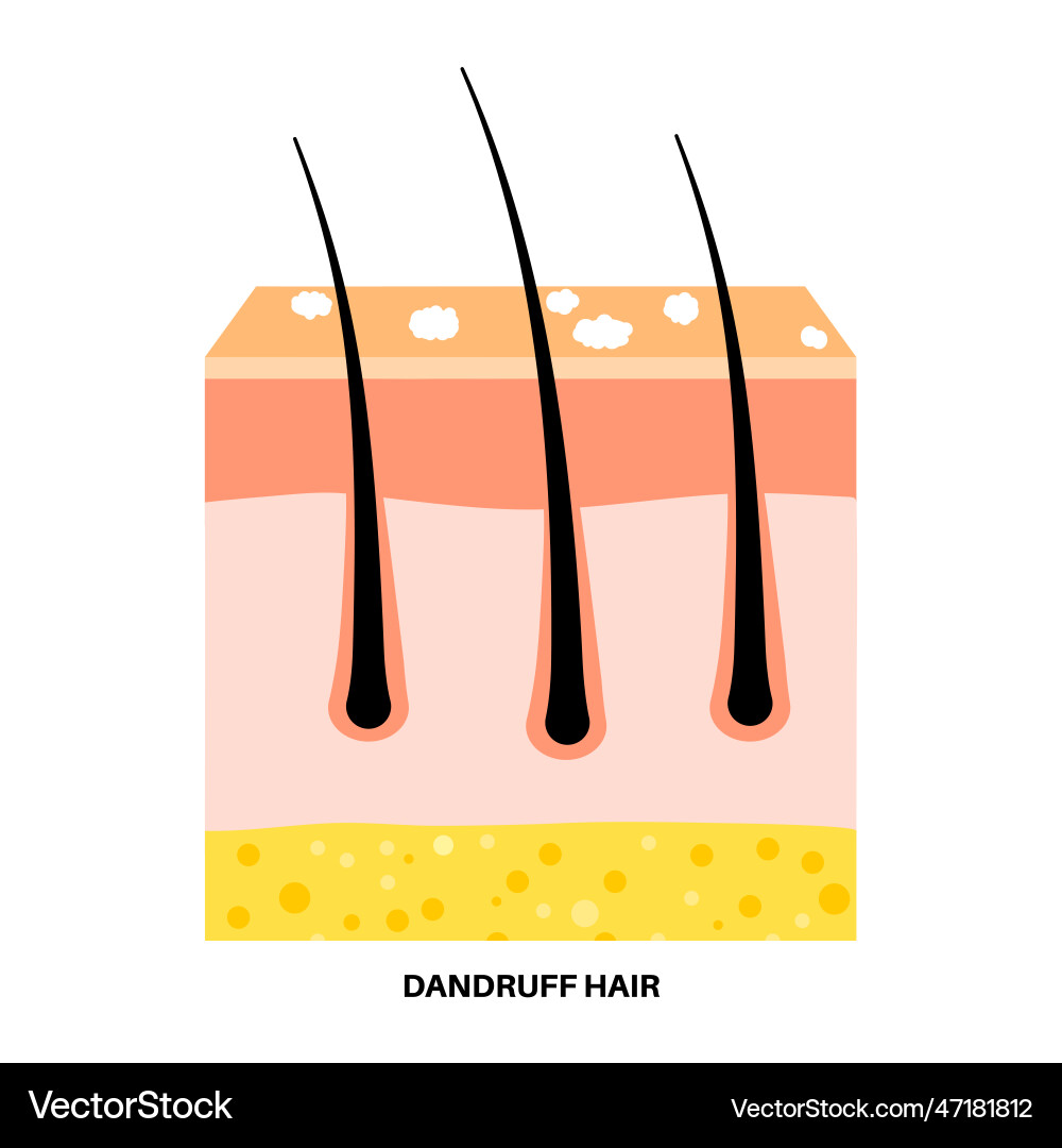 Dandruff hair poster Royalty Free Vector Image