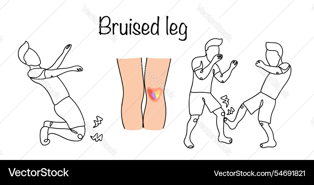 Bruised leg Royalty Free Vector Image - VectorStock