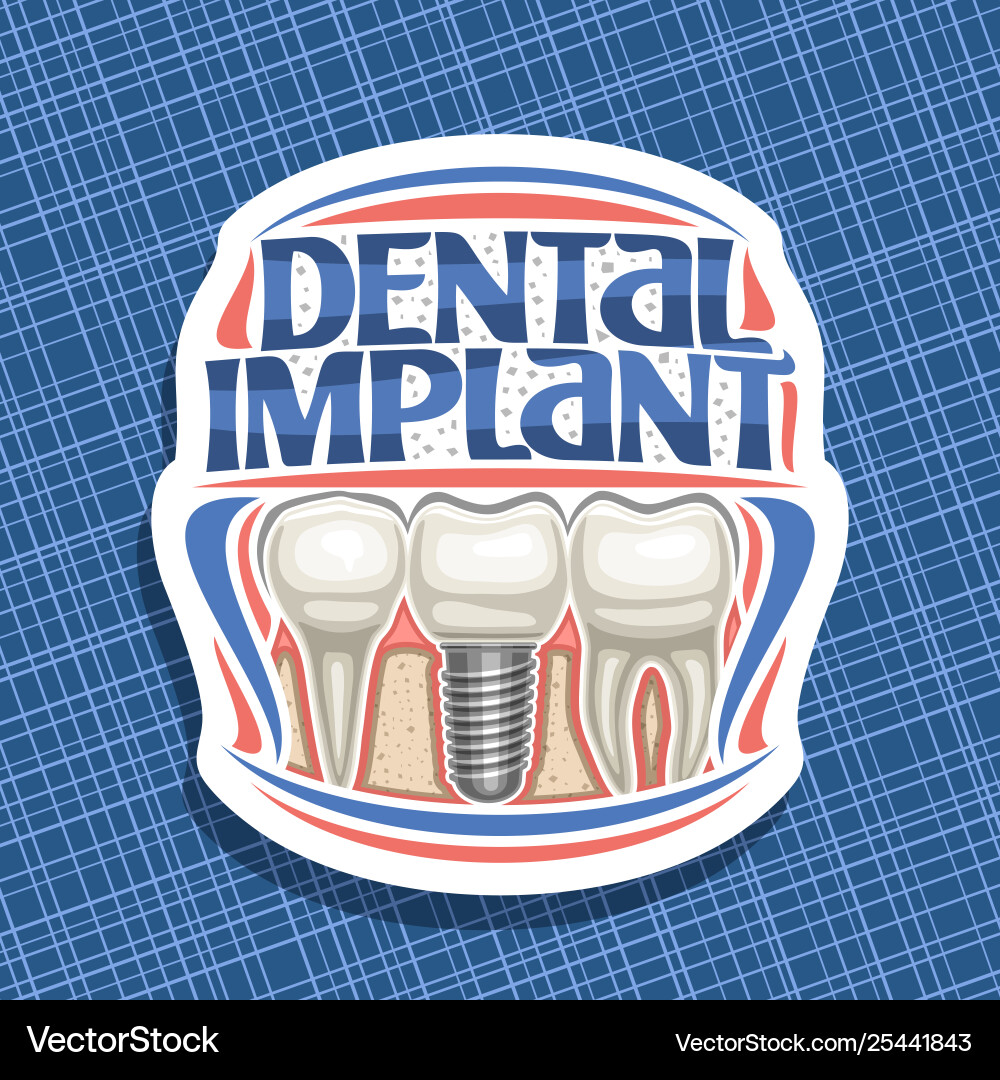 Logo for dental implant Royalty Free Vector Image