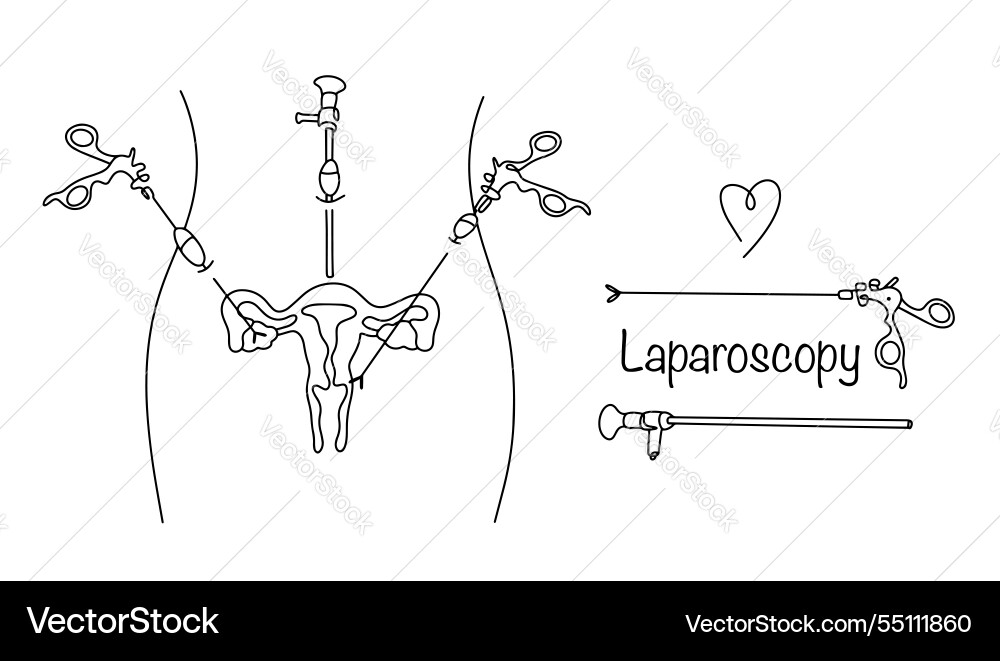 Laparoscopy Royalty Free Vector Image - VectorStock