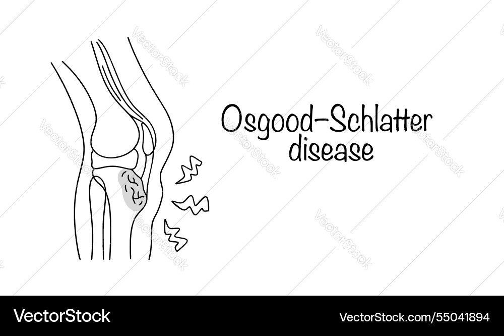 Osgoodaschlatter disease Royalty Free Vector Image