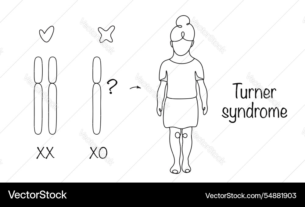 Turner syndrome Royalty Free Vector Image - VectorStock