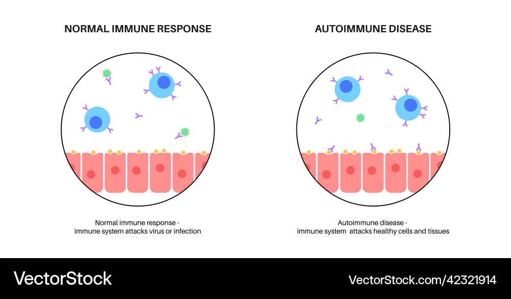 Autoimmune hepatitis disease Royalty Free Vector Image